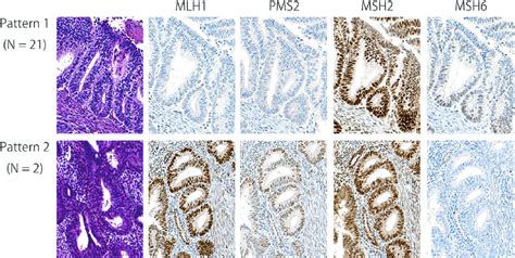 Immunohistochemical Patterns Of Mismatch Repair Deficient Endometrial Download Scientific