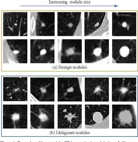 figure 1 from multi scale multi view model based on ensemble attention for benign malignant lung