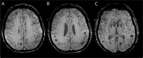 Teaching Neuroimages Distinct Brain Microhemorrhage Pattern In