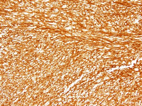Pathology Outlines Gastrointestinal Stromal Tumor Gist