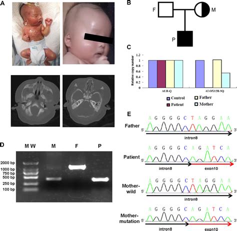 Frontiers Identification Of The First Congenital Ichthyosis Case Caused By A Homozygous