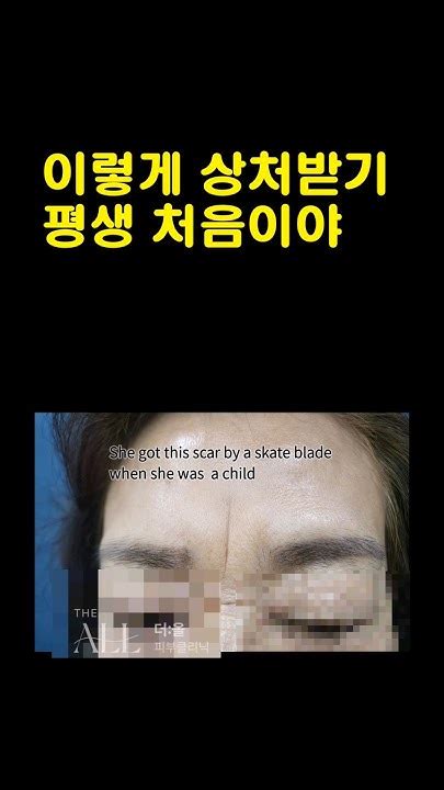 오래된 미간 흉터치료 흉터흉터치료서브시전피부큐어젯쥬베룩scarscartreatmentsubcisionbiostimulator