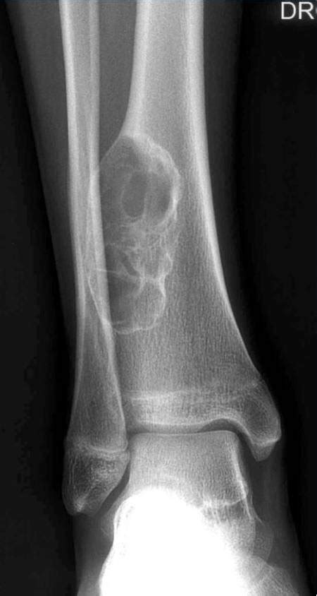 Tumeur Osseuse Wiki Hôpital Rp Fr Greys Anatomy Amino