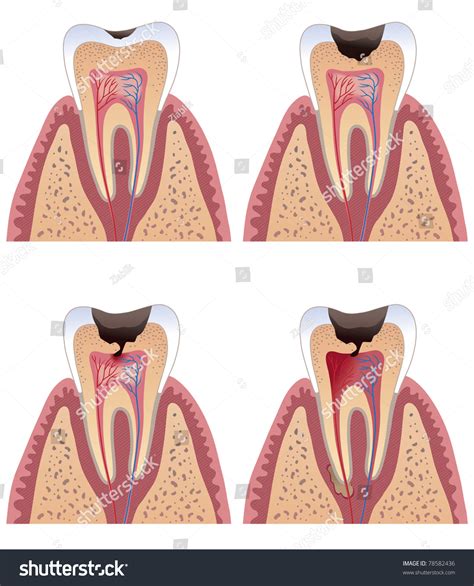 Dental Caries Process Diagram At Gabrielle Pillinger Blog