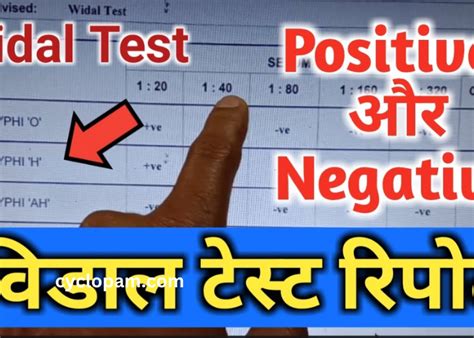 S Typhi O Positive Means Understanding Its Significance