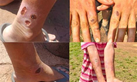 Is There An Outbreak Of Staphylococcus In Pretoria Rekord