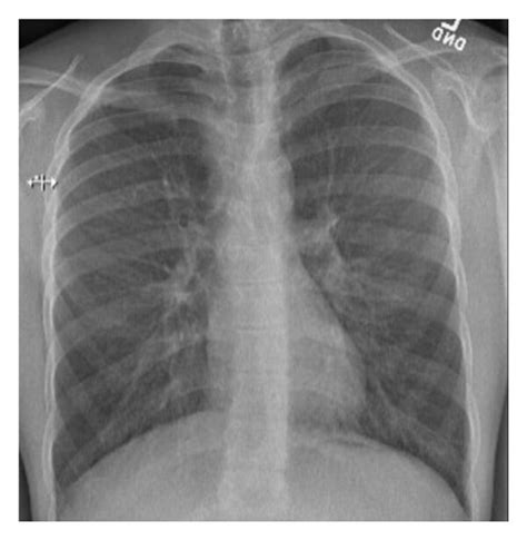 A Posterior Anterior Chest X Ray Reveling Diffuse Fine Download