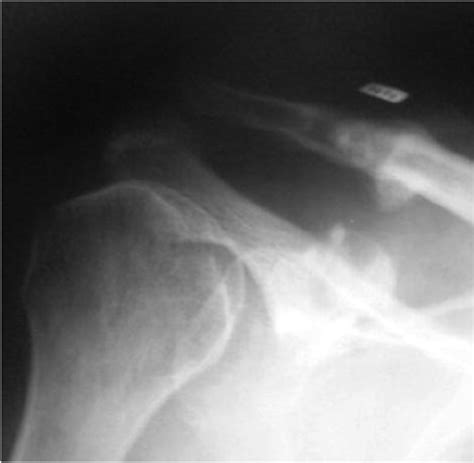 Postoperative Radiograph Demonstrating Fracture Of The Coracoid