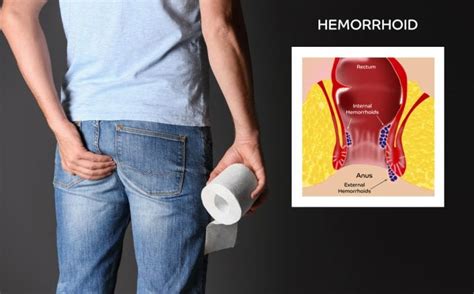 Symptoms Of Hemorrhoids Early Signs And Common Causes