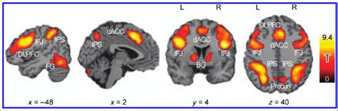 Brain Activation For The Stroop Task Incongruent Congruent Results Download Scientific