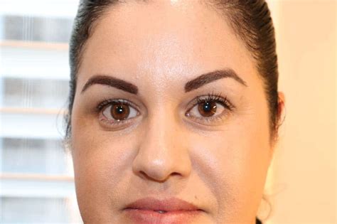 Custom Made Prosthetic Eyes Integrated Ocular Prosthetics