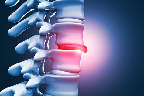 What Is Lumbar Disc Herniation Atlantic Spine Specialists