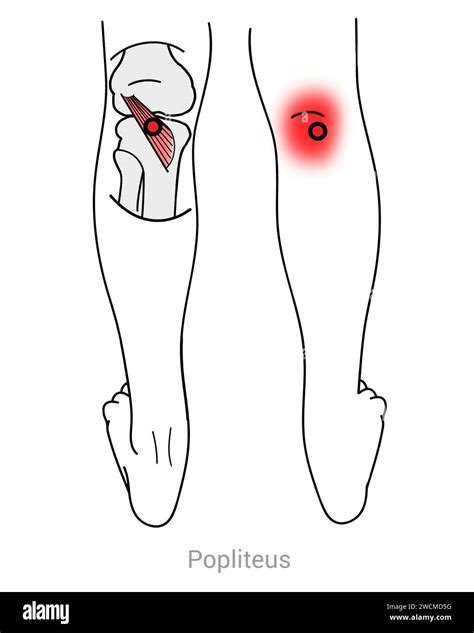 Popliteus Myofascial Trigger Points And Associated Pain Locations