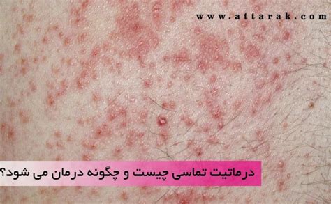 درماتیت تماسی چیست و چگونه درمان می شود؟ عطارک