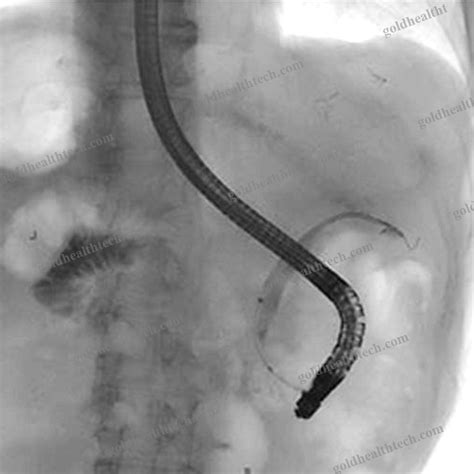 Endoscopic Retrograde Cholangiopancreatography Software Gold Health Tech