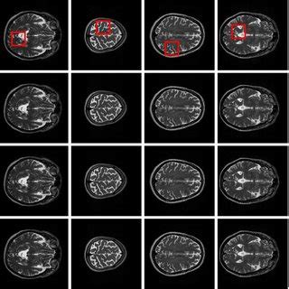PDF Super Resolution MRI Through Deep Learning