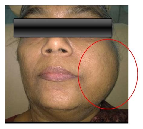 Zygomatic Swelling