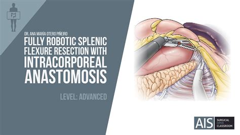 AIS Channel Fully Robotic Splenic Flexure Resection With Intracorporeal Anastomosis