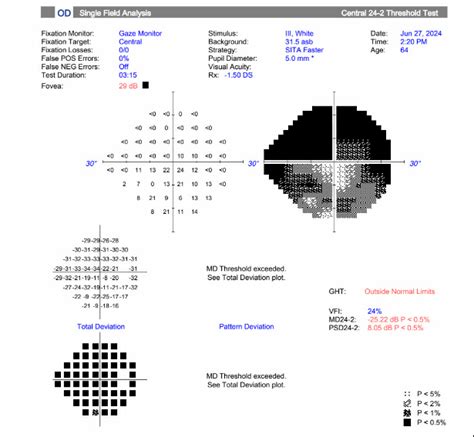 Moran Core Lens Induced Glaucoma Overview And Case Report