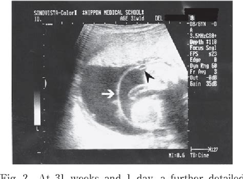 Figure 2 From A Case Report Of Complete Chorioamniotic Membrane Separation Semantic Scholar