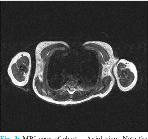 Figure 1 From Primary Closure Of A Sternal Cleft In A Neonate Semantic Scholar