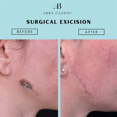 Surgical Excision Dr Abby Clinic