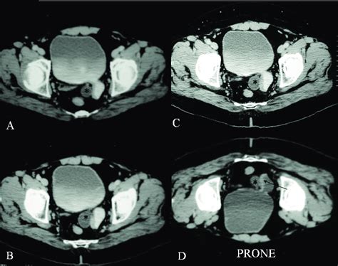 Axial Post Contrast Ct Scans Obtained In A C Supine And D Prone Download Scientific Diagram