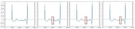 Electrocardiogram Recognization Based On Variational Autoencoder Intechopen