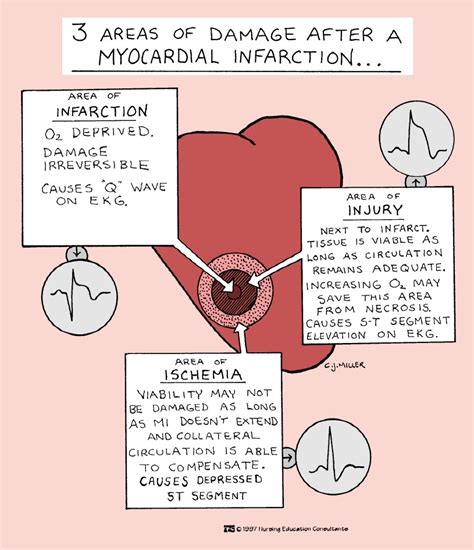 Myocardial