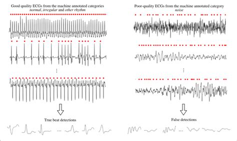 Compiling The Events Ie True Beat Detections And False