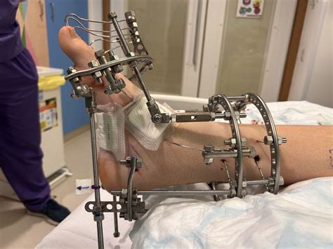 Constrained Vs Unconstrained Ilizarov Foot Methods Video Constrained Nick Green