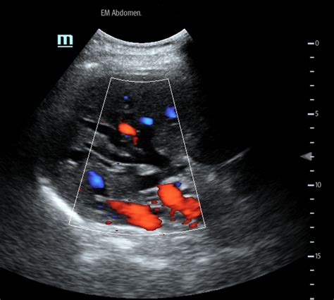 Cholangiocarcinoma Ultrasound