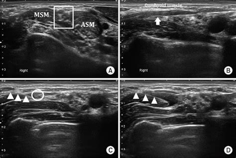 Ultrasound Image Of Proximally Approached Suprascapular Nerve Block