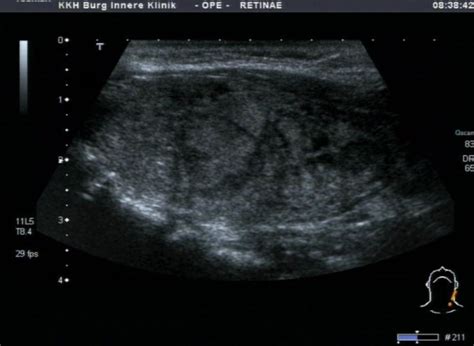 Multinodular Goiter Ultrasound