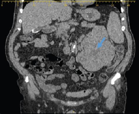 Large Retroperitoneal Leiomyosarcoma International Journal Of Recent Surgical And Medical Sciences