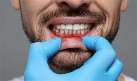 The Truth About Canker Sores Why They Appear