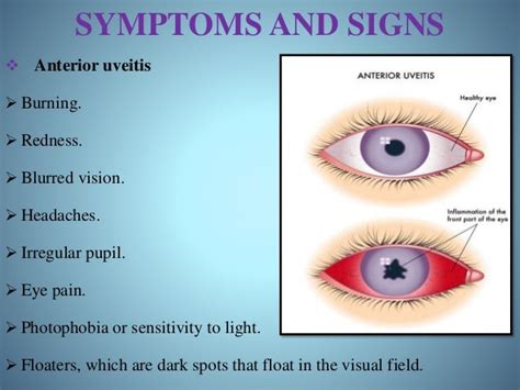 Uveitis Ppt