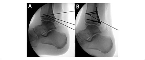 A Lateral Fluoroscopic Image With Provisional Fixation Of The