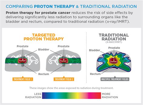 Prostate Cancer Treatment Provision Cares Proton Therapy Knoxville