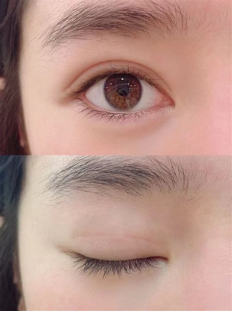 不同类型的肿泡眼应选择哪种手术方式邢台哪家可以做 哔哩哔哩