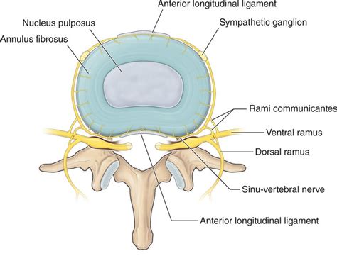 Intradiscal Electrothermal Therapy Anesthesia Key