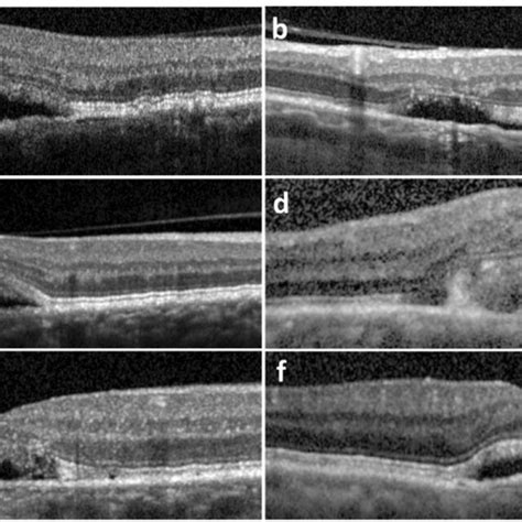 Comparison Of Liquefaction Patterns In Pseudohypopion Stage In Eyes