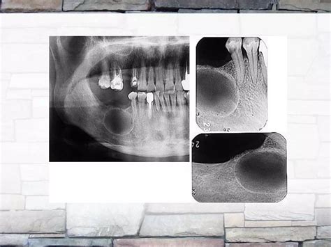 Causes Of Odontogenic Cyst Pptx Dental Health Diseases And Conditions