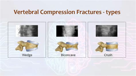 Solution Vertebral Compression Fractures Studypool