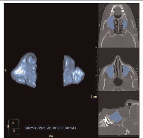 Figure 2 From Maxillary Sinus Volume And Mucosal Thickening According