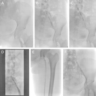 Representative DSA Images Of A Patient Underwent ART Without Stent DSA Download Scientific