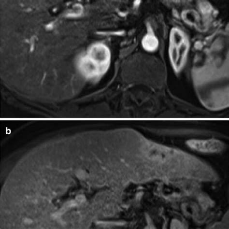 4 Intrahepatic Mass Forming Cholangiocarcinoma A A 78 Year Old
