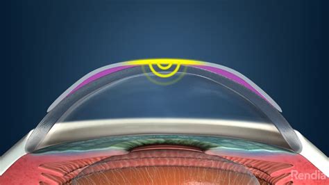 Corneal Molding Corneal Molding Clarity Advanced Eyecare Corneal