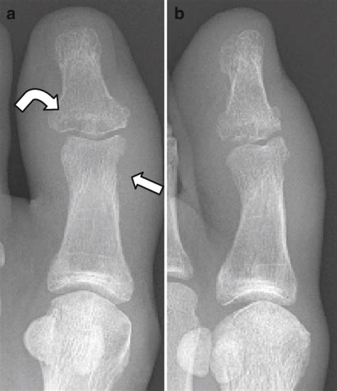 A Anteroposterior And B Oblique Radiographs Of The Left Hallux 4 Months Download Scientific