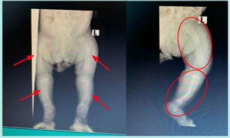 X Ray Lower Extremity Bilateral Ap Lateral View Findings Bowing Os